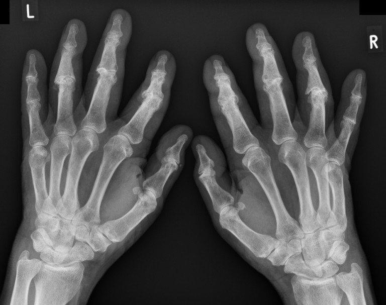 Artrose Tem Cura? O Que é, Sintomas e Tratamento - MundoBoaForma