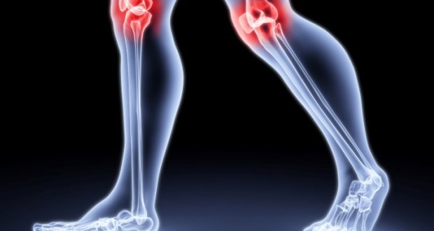 Artrose Tem Cura? O Que é, Sintomas e Tratamento - MundoBoaForma.com.br