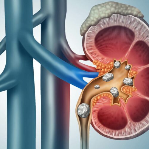 8 Sintomas de Pedras nos Rins - MundoBoaForma