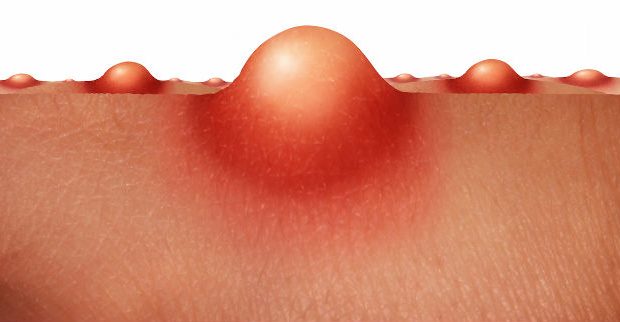 Furúnculo - O Que é, Remédio, Pomada, Tratamento Caseiro e Cuidados ...