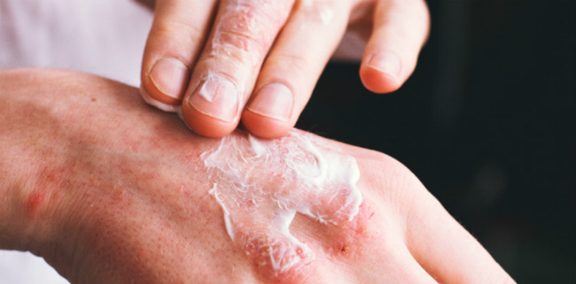 Doença Pelagra - Causas, Sintomas e Tratamento - MundoBoaForma