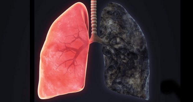 Enfisema Pulmonar - O Que é, Sintomas, Causas e Tratamento ...