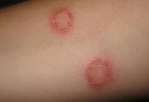 Impinge? O Que é? Causas, Sintomas E Tratamento