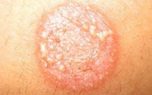 Impingem - O que é, causas, sintomas e tratamento - MundoBoaForma