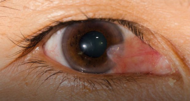 Pterígio no Olho - O Que é, Causas, Colírio, Tratamento, Cirurgia e ...