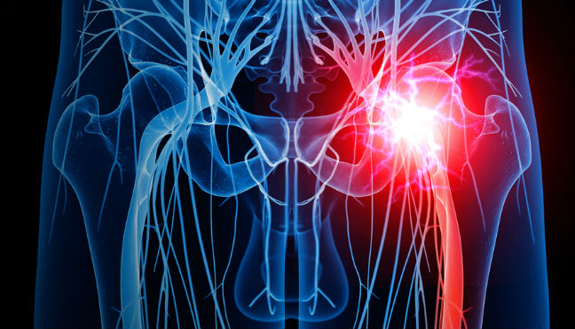 Síndrome do Piriforme - O Que é, Sintomas e Tratamento - MundoBoaForma