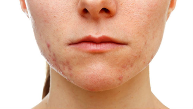 Como Secar Espinha Inflamada - Dicas e Cuidados﻿ - MundoBoaForma