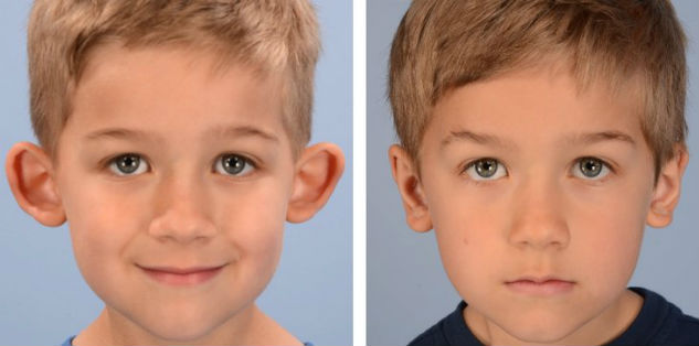 Otoplastia - O Que é, Pós-Operatório, Preço e Cuidados - MundoBoaForma