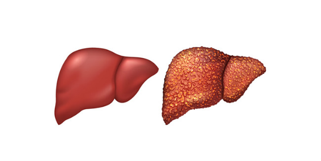 Cirrose hepática: sintomas, causas e tratamento - MundoBoaForma