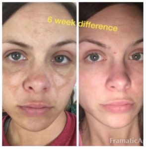 Hidroquinona - O Que é, Para Que Serve, Antes e Depois e Como Usar ...