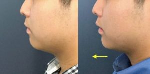 Preenchimento de Queixo - Antes e Depois, Resultados e Depoimentos ...