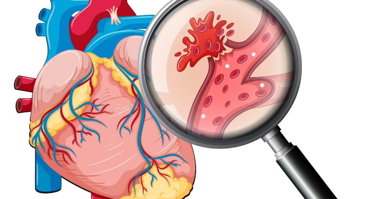 10 principais sintomas de embolia pulmonar - MundoBoaForma