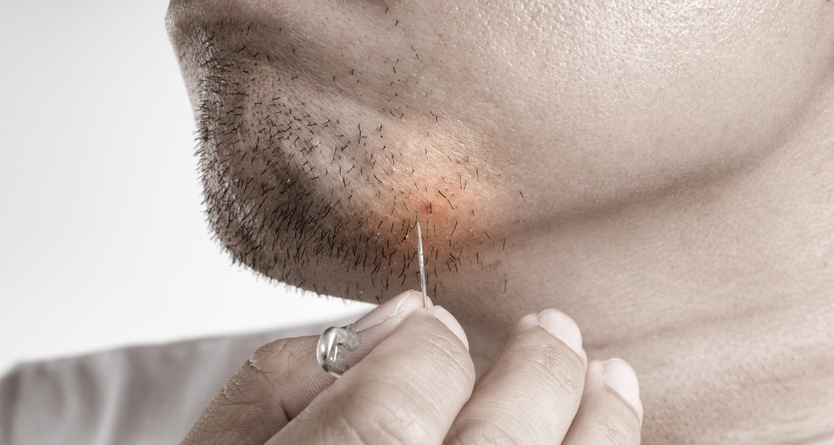 Foliculite - Causas, sintomas e tratamento - MundoBoaForma