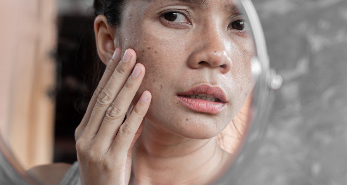 Melasma - O que é, sintomas e como tratar - MundoBoaForma