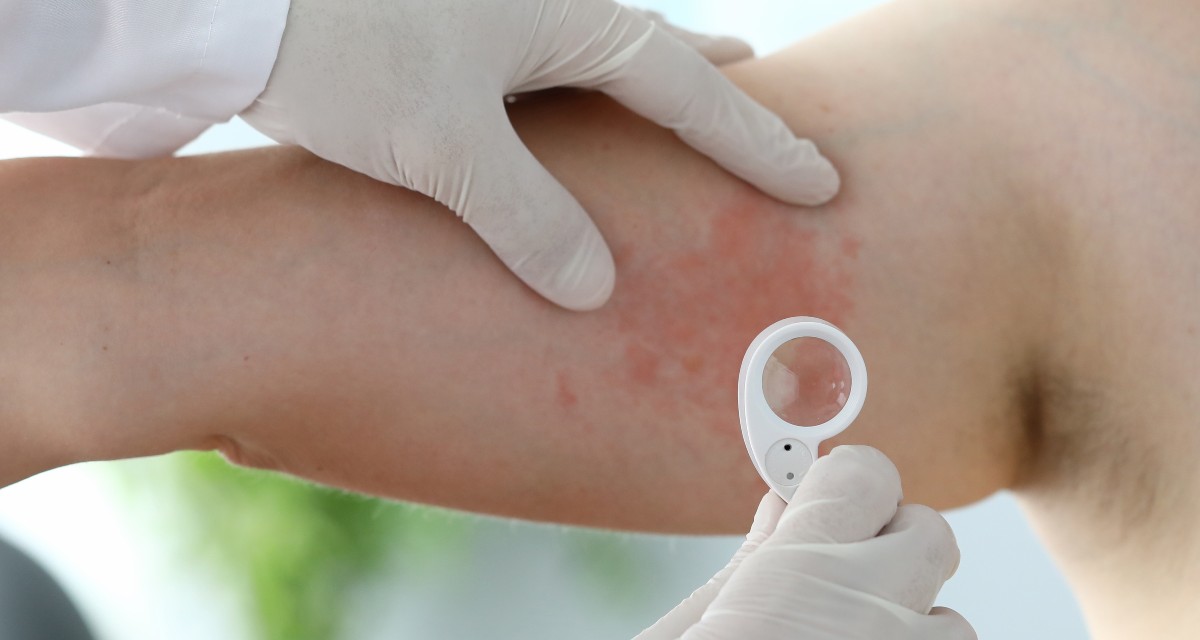 Hanseníase - O que é, sintomas e como tratar - MundoBoaForma