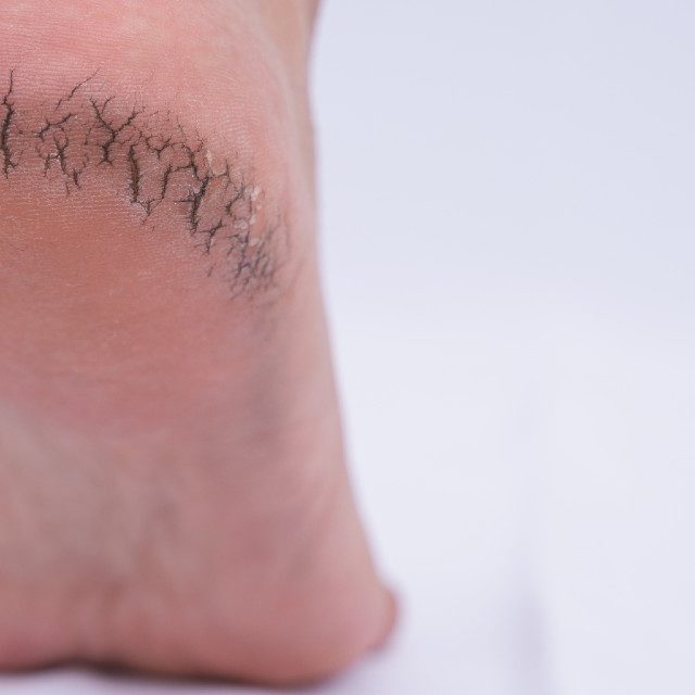 Dor no calcanhar - Causas e como tratar - MundoBoaForma