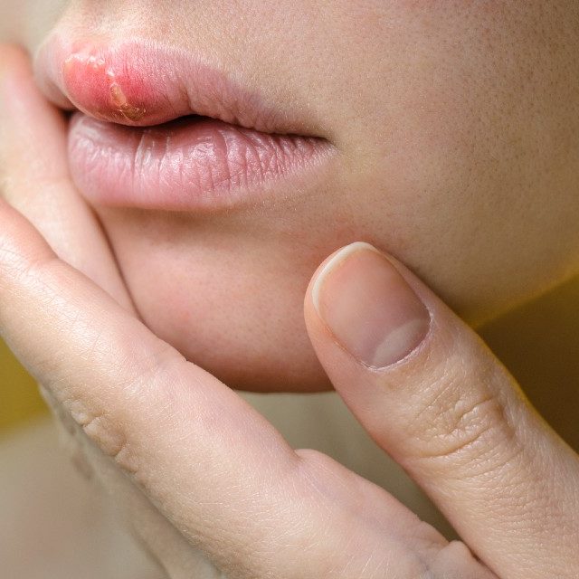 Causas da Língua Inchada e Como Tratar - MundoBoaForma