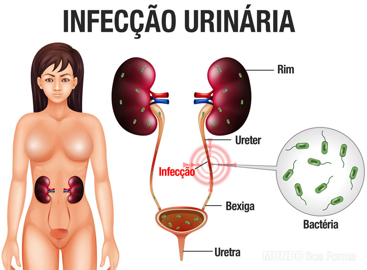 Remédio Para Infecção Urinária Os 5 Mais Usados