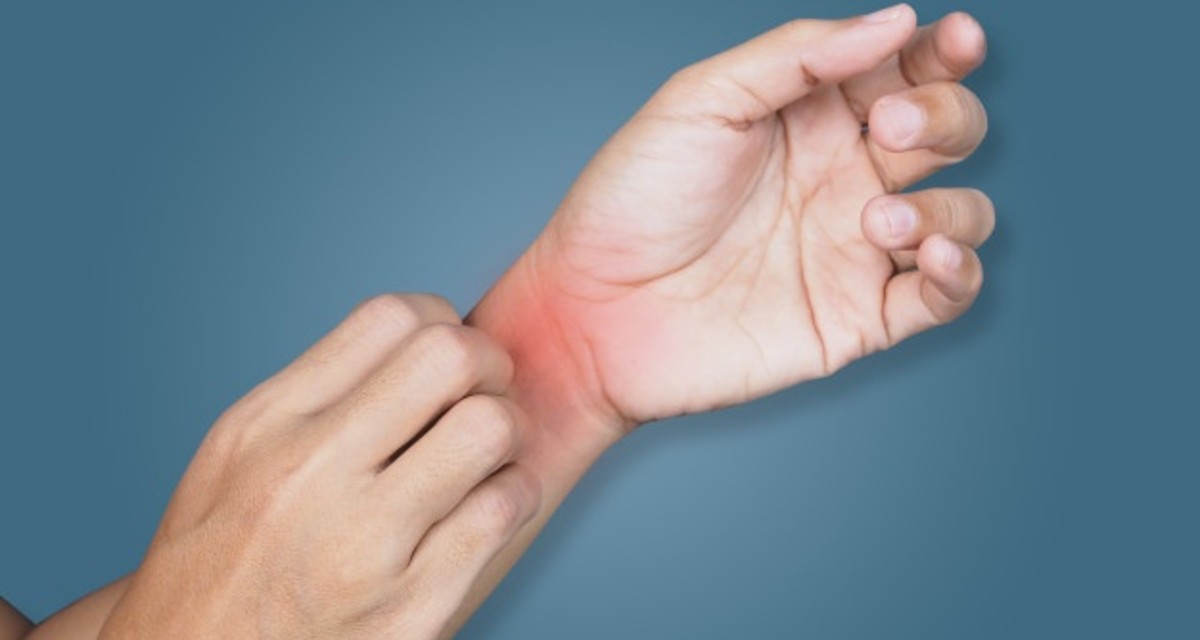 Micose - Tipos e como tratar - MundoBoaForma