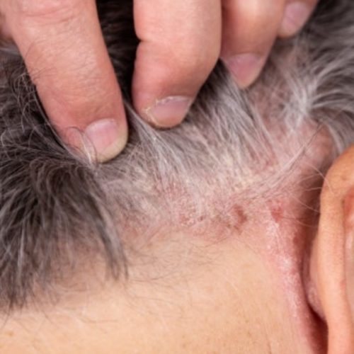 Ferida Na Cabeça Causas E Como Tratar Mundoboaforma