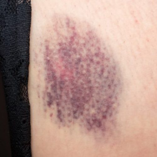 Manchas roxas na pele - Causas e como tratar - MundoBoaForma