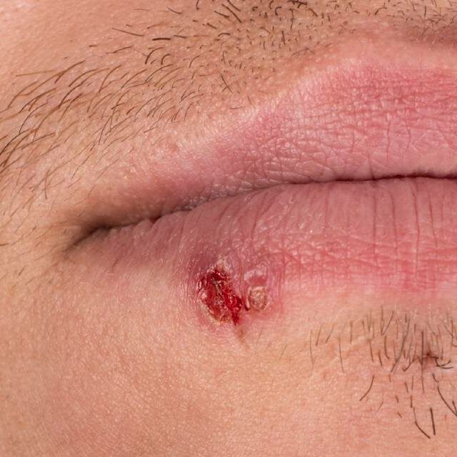 Melhores pomadas para herpes labial e como usar - MundoBoaForma