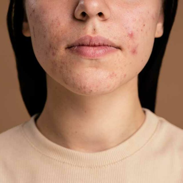 Muitas Espinhas no Rosto de Repente - O Que Pode Ser? - MundoBoaForma