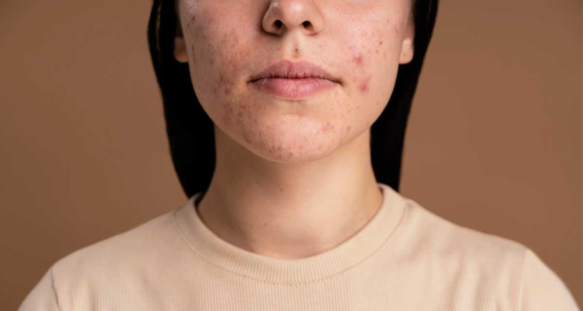 O que causa espinhas e como tratar? - MundoBoaForma
