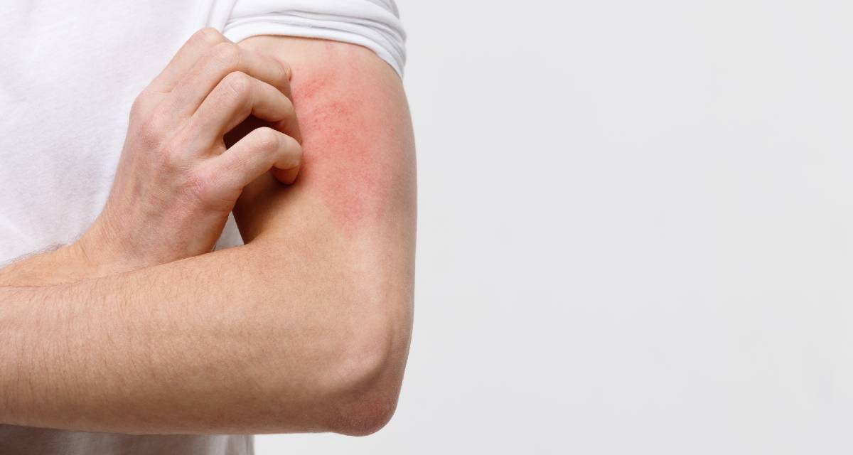 Líquen plano: o que é, sintomas, causas e tratamento - MundoBoaForma