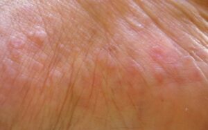 Líquen plano: o que é, sintomas, causas e tratamento - MundoBoaForma