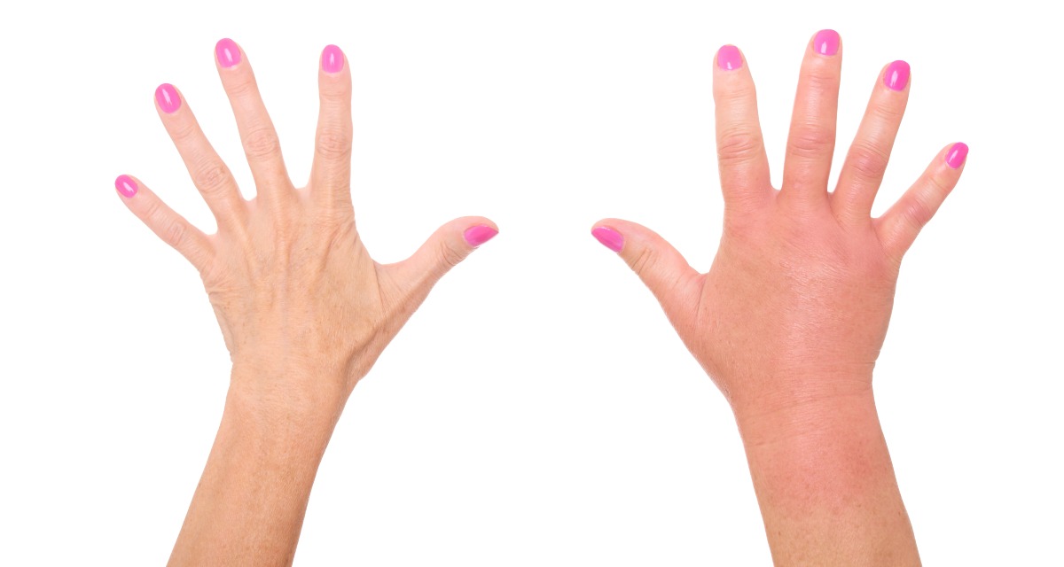 Inchaço nas mãos e dedos: 10 principais causas e o que fazer ...