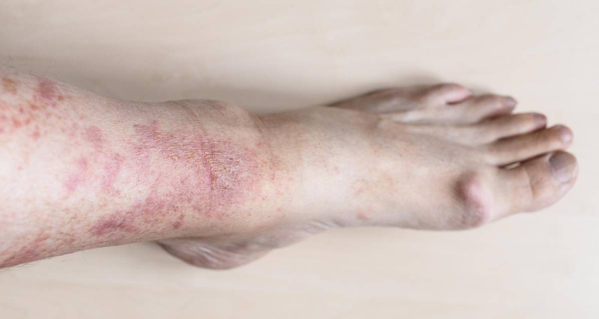 Rubéola: o que é, sintomas, causas e possíveis tratamentos - MundoBoaForma