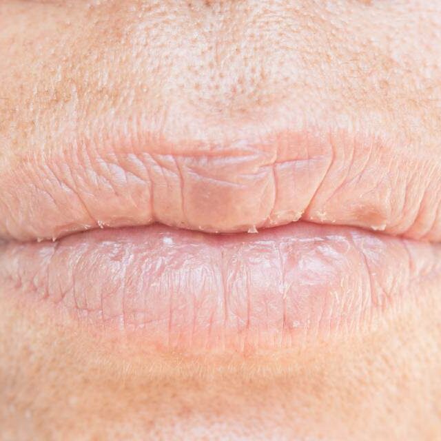 Causas de boca inchada e como tratar - MundoBoaForma