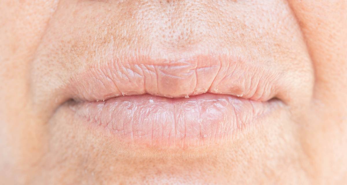 Boca seca (xerostomia): o que é, causas, sintomas e o que fazer ...