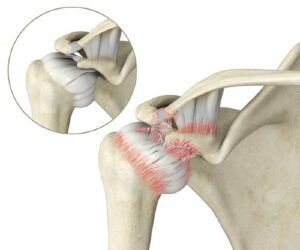 Capsulite adesiva: o que é, sintomas, causas e tratamentos - MundoBoaForma