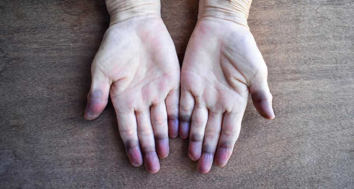 Cianose: o que é, tipos, sintomas, causas e tratamentos - MundoBoaForma