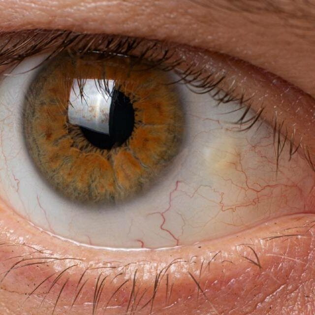 Bolha na parte branca do olho: causas e tratamentos - MundoBoaForma