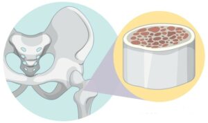 Biópsia de medula óssea: quando é indicada e como é feita - MundoBoaForma