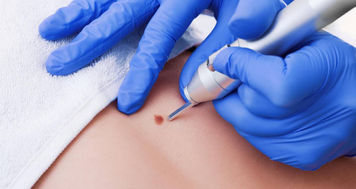 Como é feita a crioterapia para verrugas - MundoBoaForma