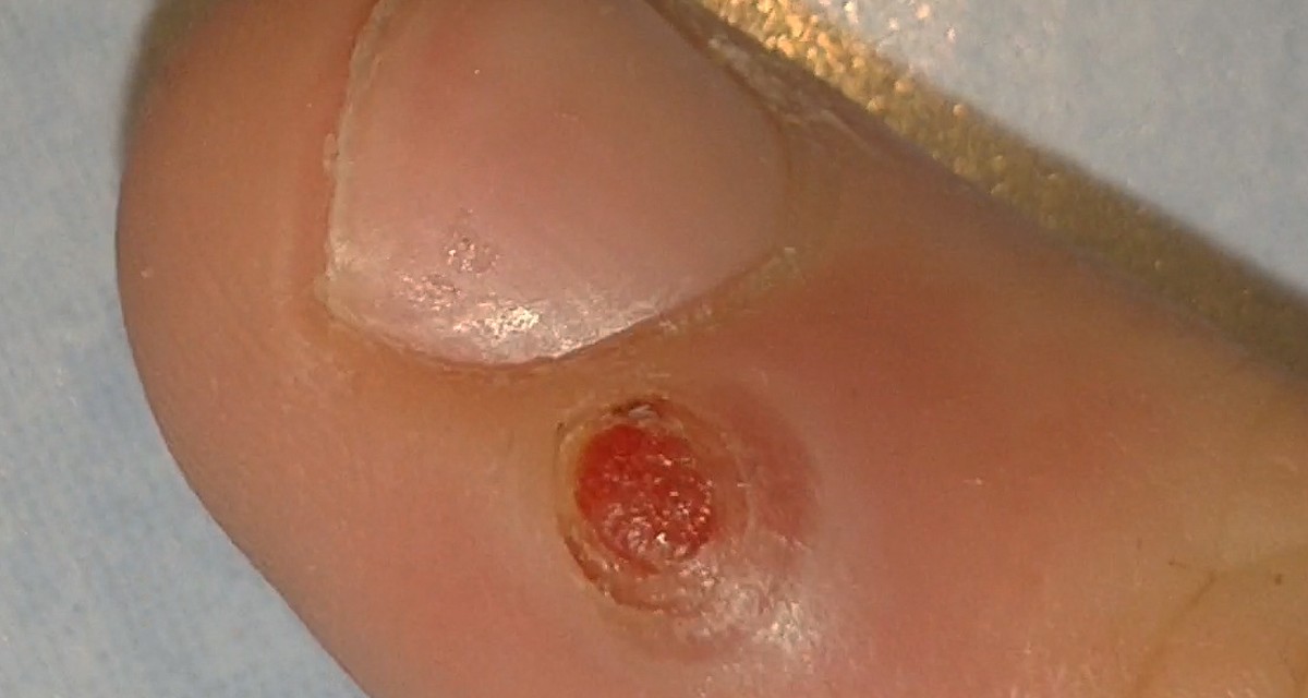 Granuloma piogênico: o que é, sintomas, causas e tratamentos ...