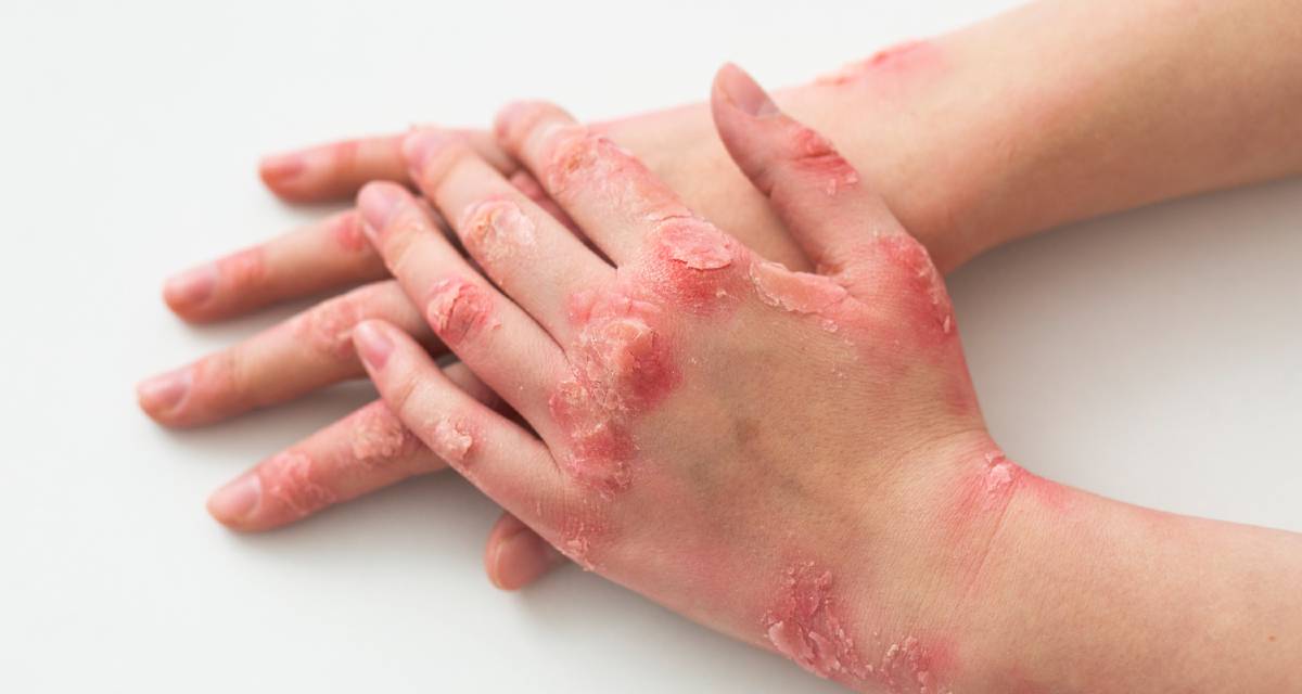 Esporotricose humana: o que é, sintomas, tipos e tratamento - MundoBoaForma