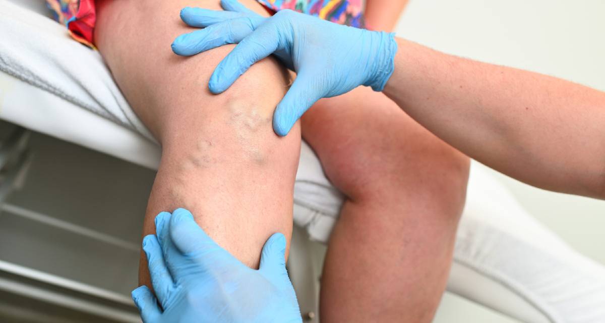 Linfedema: o que é, sintomas, causas, tipos e tratamento - MundoBoaForma