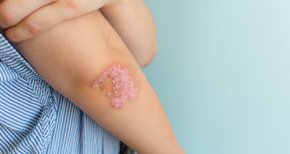Piodermite: o que é, tipos, sintomas e tratamento - MundoBoaForma