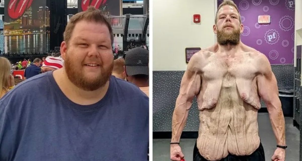 Homem perde 163 kg e precisa de três cirurgias para retirar o excesso ...