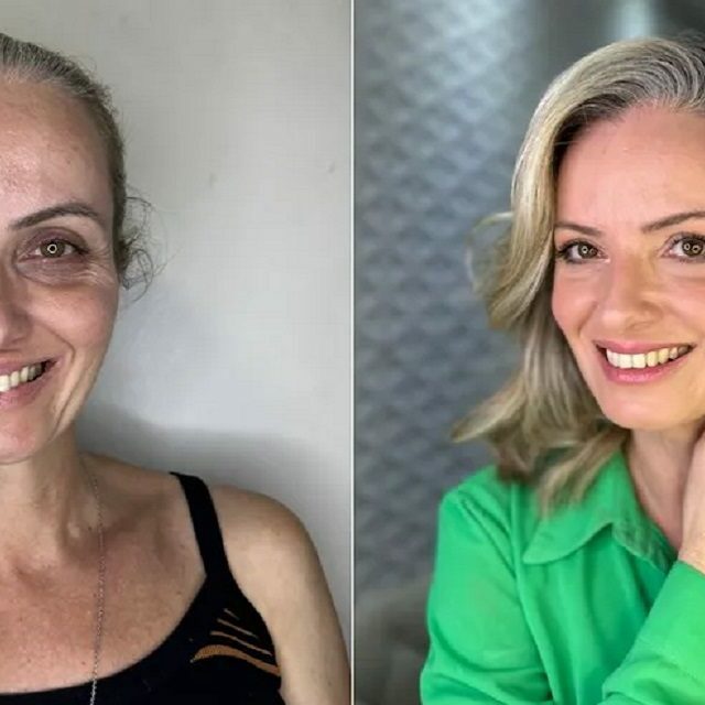 Peeling de fenol: conheça riscos do procedimento após morte de jovem de ...