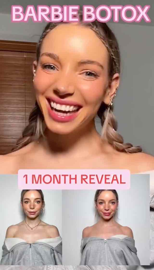 Barbie Botox, o procedimento estético que é a nova tendência da ...