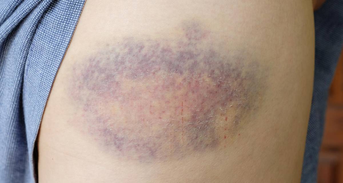 Equimose - O que é, causas e como tratar - MundoBoaForma