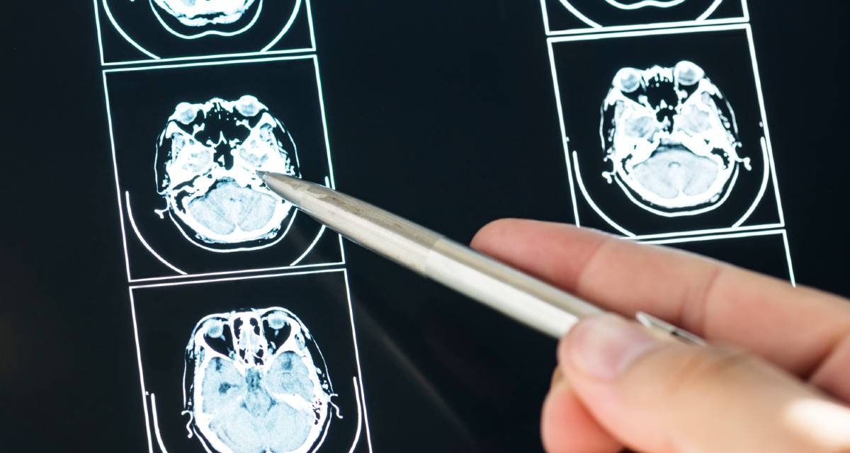Microangiopatia (gliose): o que é, sintomas, causas e tratamento ...