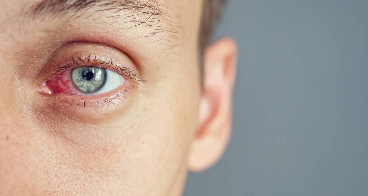 Quemose: O que é, sintomas, tratamentos e causas - MundoBoaForma