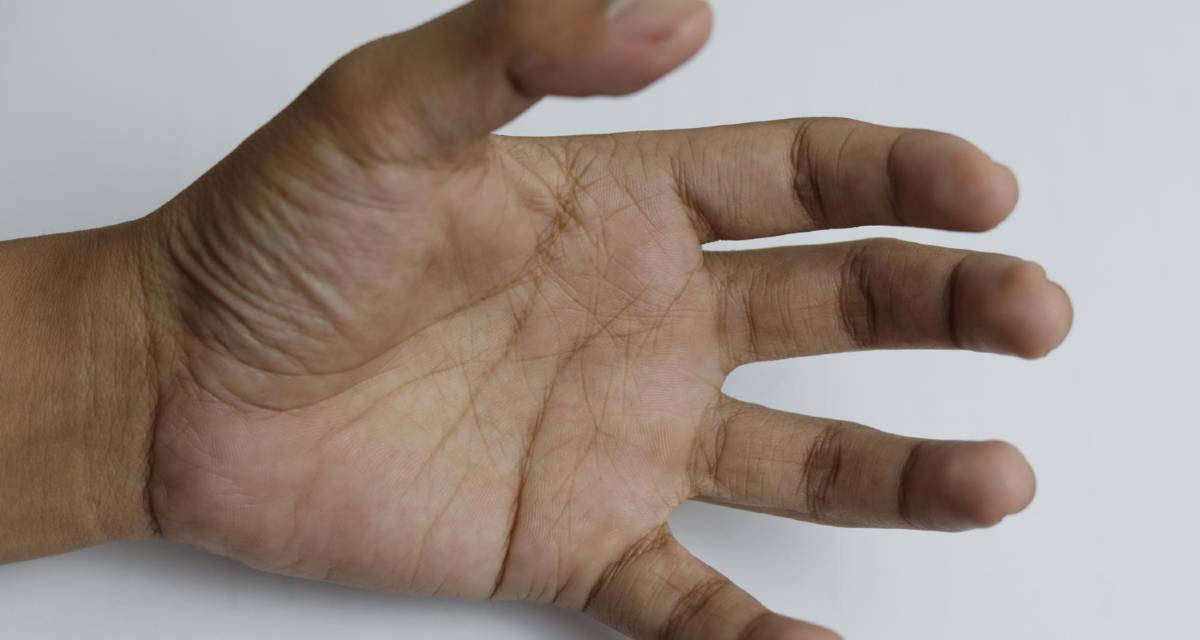 Espasticidade: o que é, causas, sintomas e tratamento - MundoBoaForma